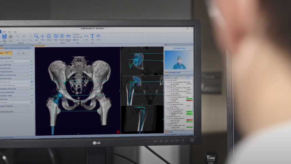 mediCAD®: The pioneering solution for precise hip surgeries, mediCAD ...