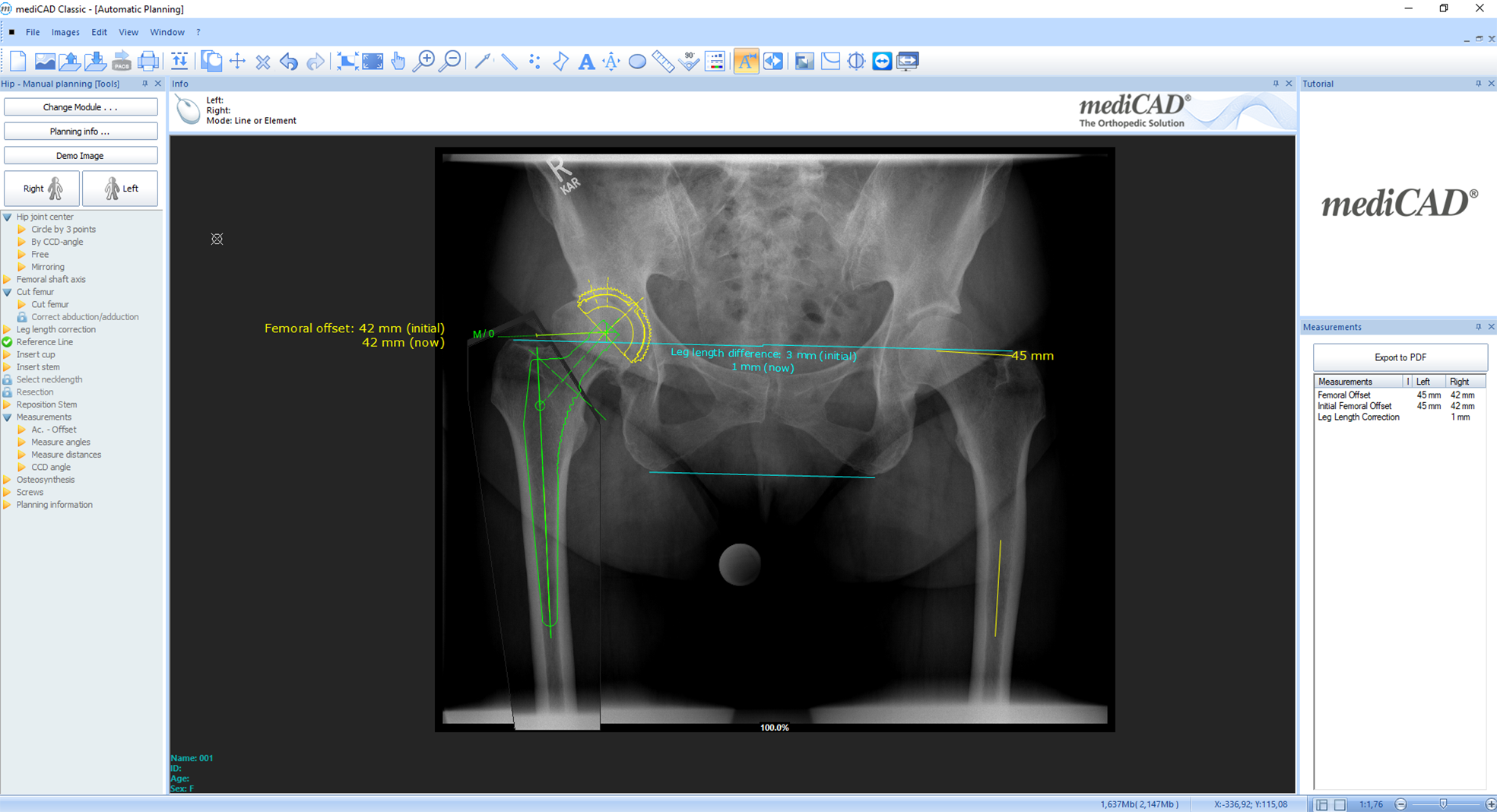 mediCAD available in syngo.via OpenApps, mediCAD Hectec GmbH, Press release - PresseBox