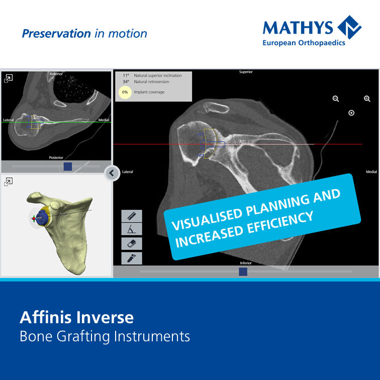 Efficient, smart and fully guided: Mathys presents the new Affinis ...