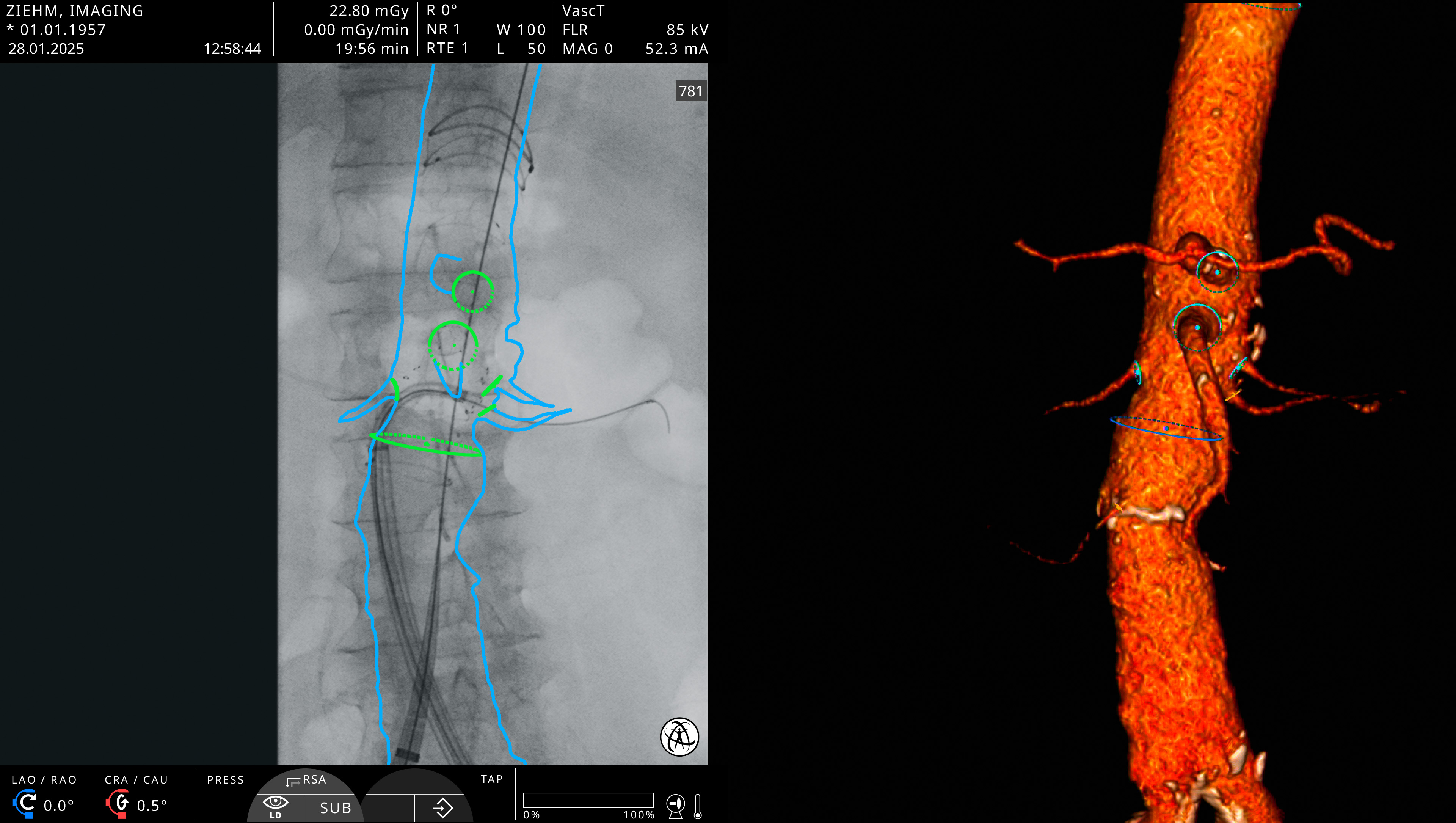 ECR 2025: Ziehm Imaging presents new solution for intraoperative endovascular procedures, Ziehm ...