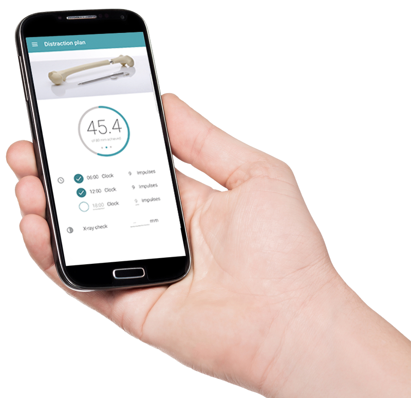 FITBONE® smartphone app lets patients actively accompany their ...