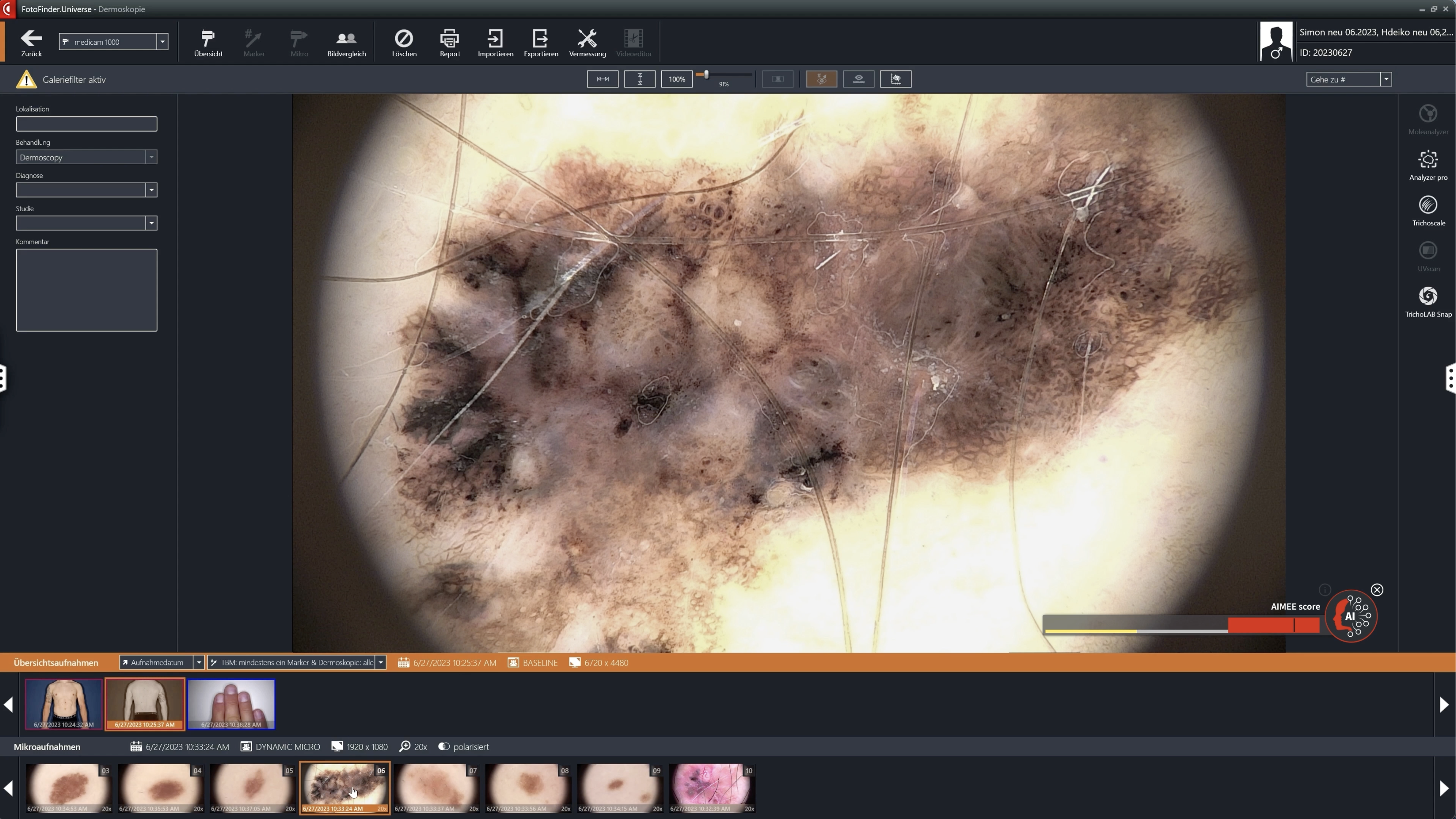 Total Body Dermoscopy mit Künstlicher Intelligenz, FotoFinder Systems ...