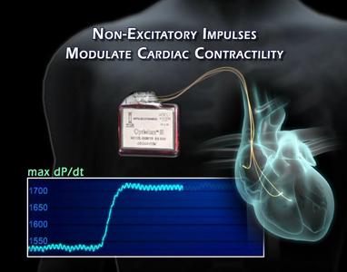 Impulse Dynamics nimmt CCM-HF Studie mit dem Optimizer System in Europa ...
